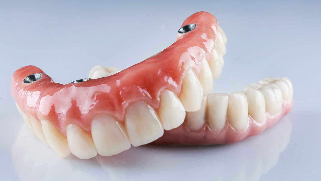 Implant-Retained Dentures | Bells Corners Dental Studio